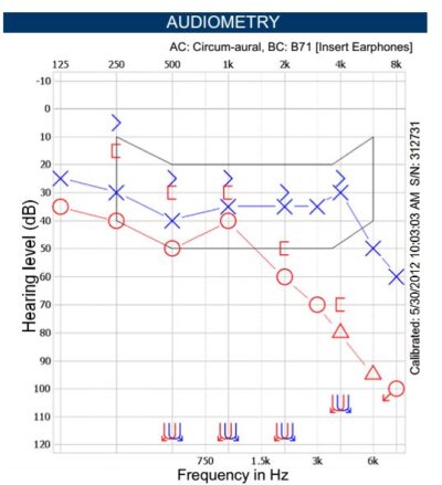 Ear Pathologies and Audiograms Part 3 Otosclerosis – TJ Audiology Training