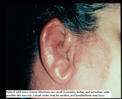 OTITIS EXTERNA – TJ Audiology Training