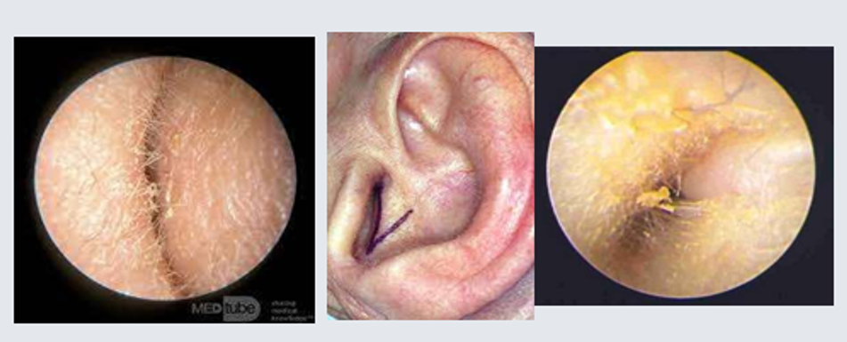 Collapsed Ear Canals : Making Earmoulds – TJ Audiology Training