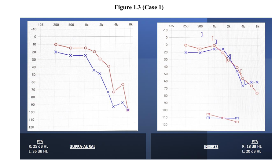 Understanding audiograms – TJ Audiology Training